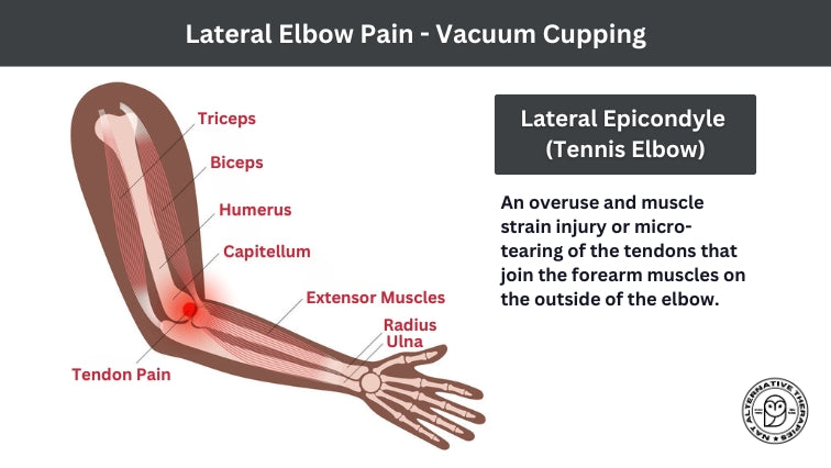 Treating Lateral Elbow Pain - Vacuum Cupping | Elbow, Tennis Elbow and ...