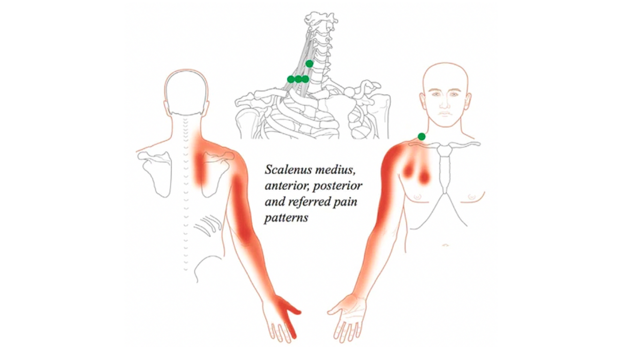 Trigger Point Therapy | Thoracic Outlet Syndrome | Scalenes, Shoulder ...
