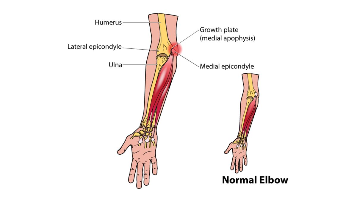 What Exactly is Little League Elbow? | Elbow, Lateral Elbow Pain and ...