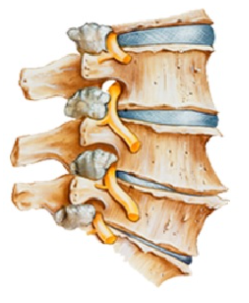Neck Arthritis (Cervical Spondylosis) - Trigger Point Therapy ...